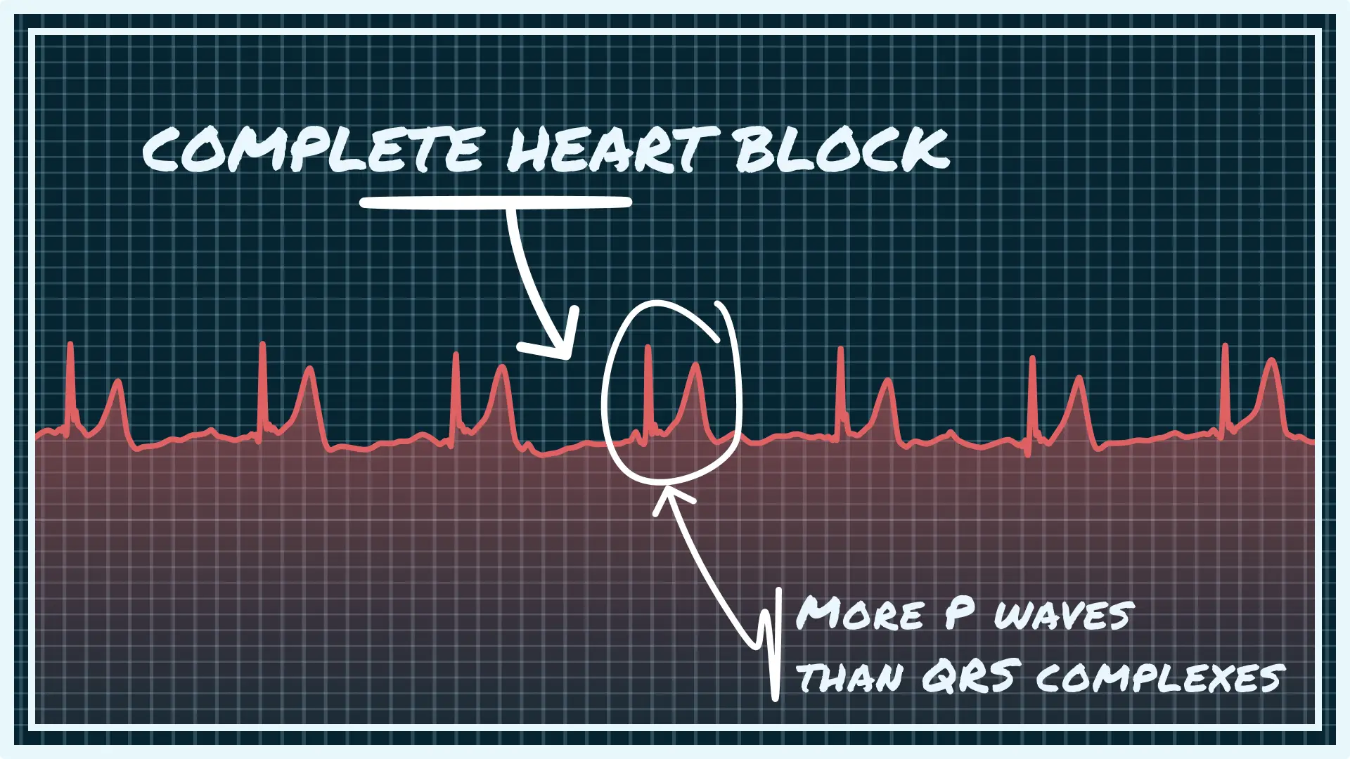 What Complete Heart Block Looks Like on Your Watch ECG | Qaly
